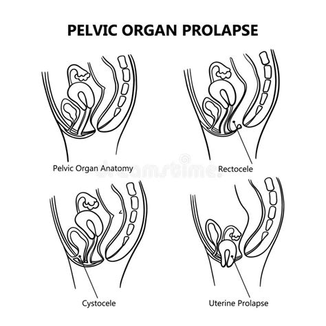 Pelvic Organ Prolapse Variously Monochrome Education Vector Set Stock