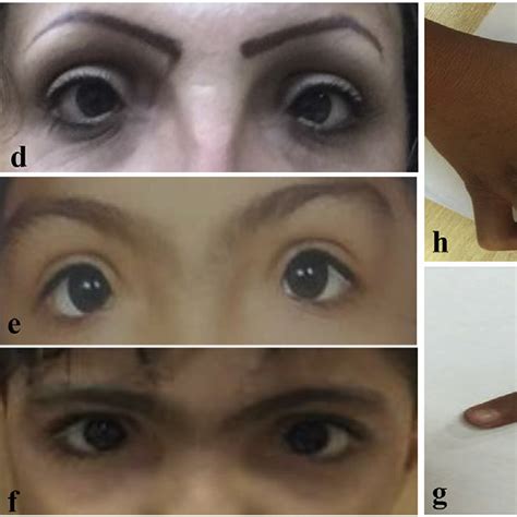 Pdf First Report Of Klein Waardenburg Syndrome In Iran And A Novel
