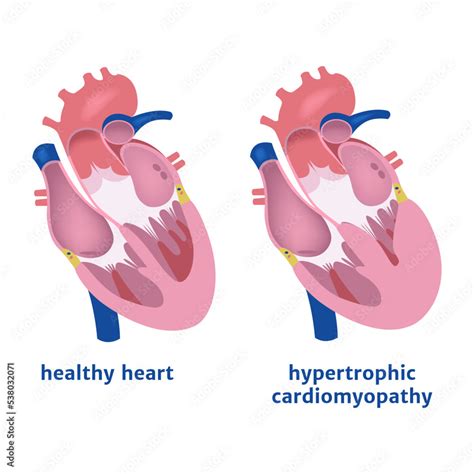 Hypertrophic Cardiomyopathy Expansion Of The Ventricle Of The Heart