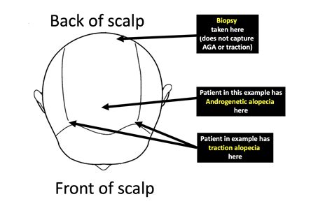 Does A Scalp Biopsy Capture All Diagnoses A Patient Has — Donovan Hair