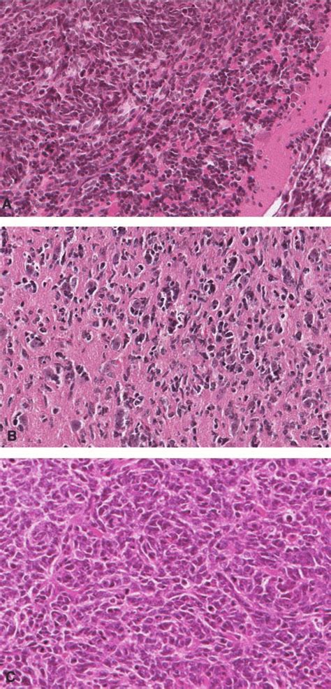 Histopathology Of Gem Primitive Neuroectodermal Tumors A Highly