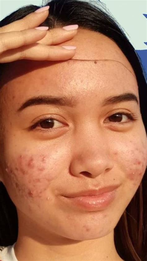 13 Skin Positive Acne Influencers Who Are Cool With Their Skin Exactly