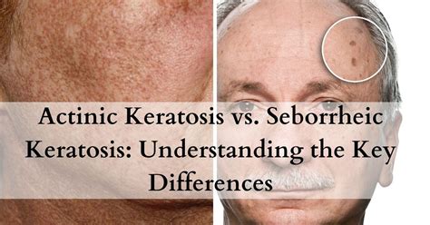 Actinic Keratosis Treatment Effective Solutions For 55 Off
