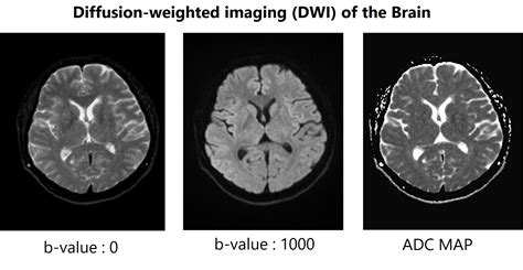Diffusion Weighted Mri Dwi Mri Sequence Physics And Image Appearance