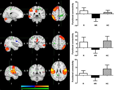 Increased Pre Treatment Functional Connectivity Between A Right