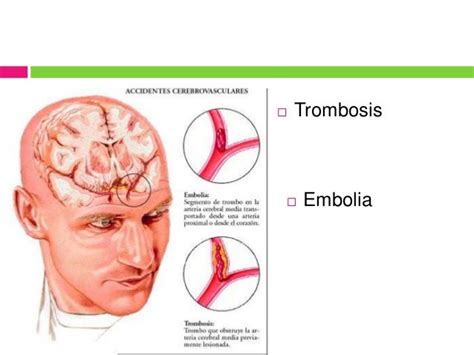 Accidente Cerebro Vascular Acv