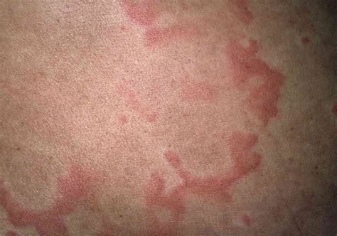 Thyroid Disease And Hives Symptoms Causes Treatment