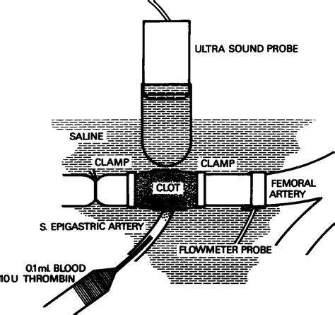 Figure 1 From Does External Ultrasound Accelerate Thrombolysis Results