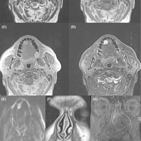 Axial T2‐weighted Mri Image Shows A Hyperintense Lesion A That Is