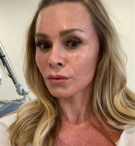 Tamra Judge Shows Off New Laser Treatment As Her Face Peels Away — Here
