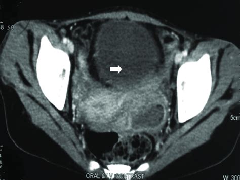 Computed Tomography With Unilateral Tubo Ovarianmass In Female Genital