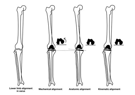 On The Left A Varus Aligned Lower Limb Is Illustrated On The Right