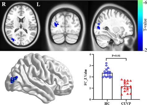 Significant Differences In Intranetwork Functional Connectivity In The