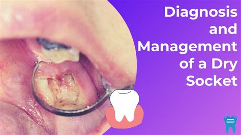 What Is A Dry Socket Diagnosis And Management Youtube