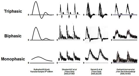 Interpretation Of Peripheral Arterial And Venous Doppler Waveforms A
