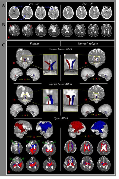 Figure 1 From Multiple Injuries Of The Ascending Reticular Activating