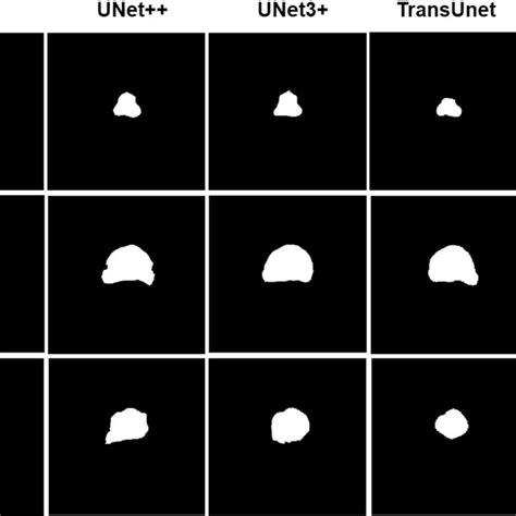 Multiscale Transunet Dense Hybrid U Net With Transformer For