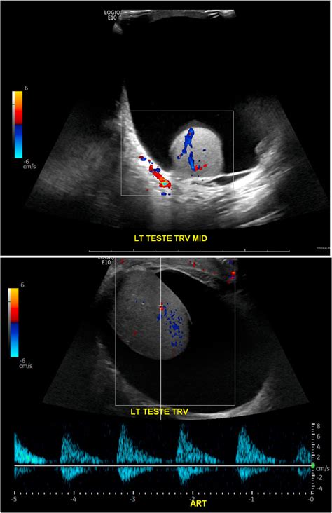 Scrotal Ultrasound Demonstrating Large Left Hydrocele With Arterial