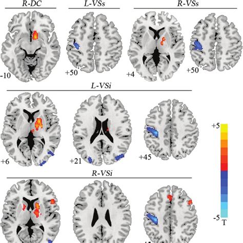 Between Group Differences In Resting State Functional Connectivity