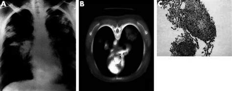 A Chest X Ray B Chest Ct Bilateral Hilar Adenopathy And Bilateral