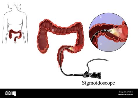 Procédure Dune Sigmoïdoscopie Colon Examen De Dépistage Du Cancer