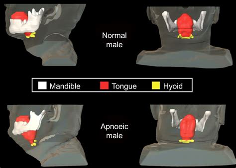 Identification Of Craniofacial Risk Factors For Obstructive Sleep