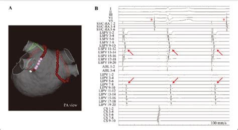 Representative A 3 D Electroanatomic Map And B Intracardiac
