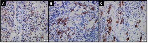 cureus bilateral gonadoblastoma with dysgerminoma in a phenotypically