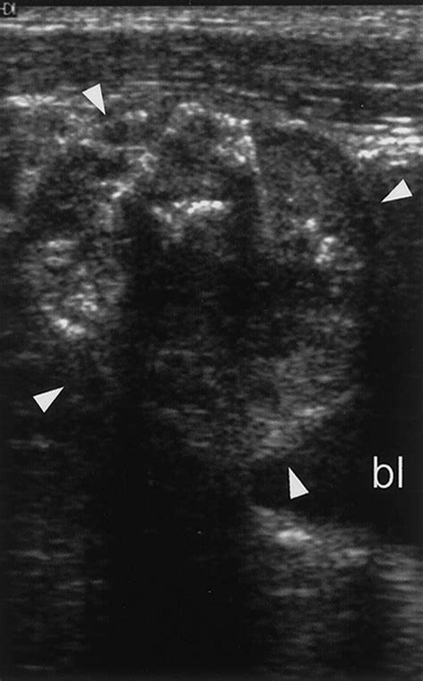 Urachal Remnant Diseases Spectrum Of Ct And Us Findings Radiographics