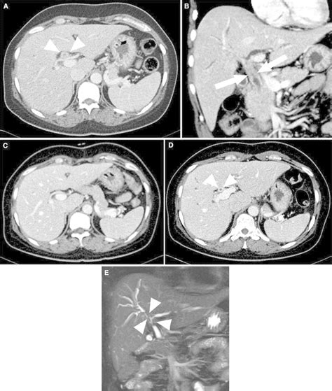 050 Year Old Woman With Igg4 Associated Cholangitis Presenting With