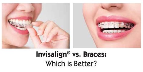 Invisalign Vs Braces Which Is Better For You
