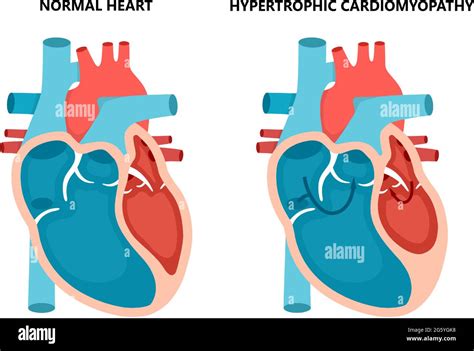 Hypertrophic Cardiomyopathy With Cross Section View Human Heart Muscle