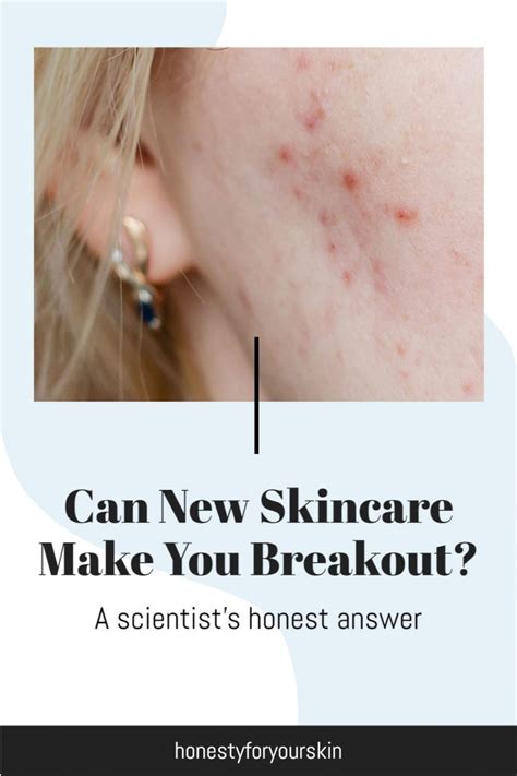 Skin Purging Vs Breaking Out Is It A Thing Honesty For Your Skin
