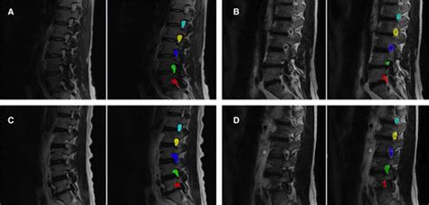 quantitative analysis of neural foramina in the lumbar spine an