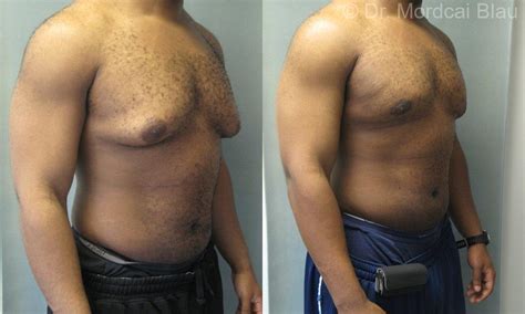Severe Gynecomastia Before And After Photos ⋆ Gynecomastia Usa