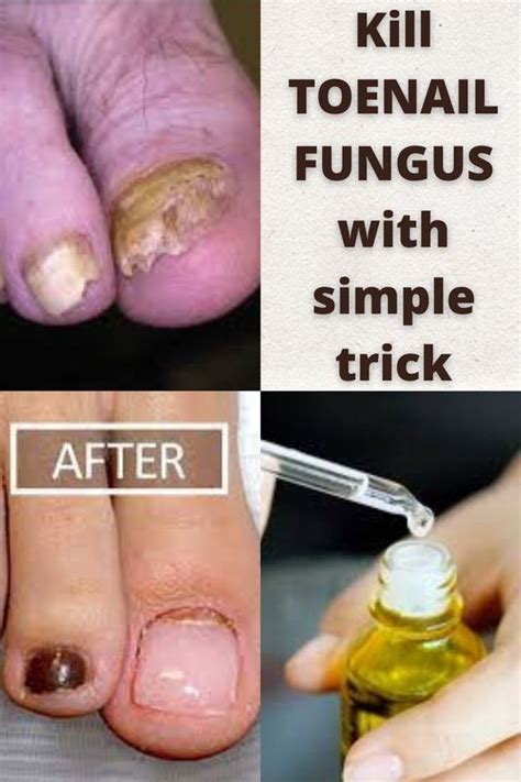 Nail Fungus Activates When You Use This Popular Treatment Artofit
