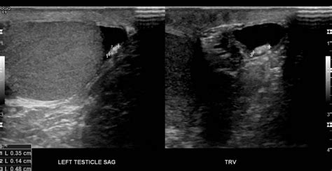 Torsed Appendix Testis Sonographic Tendencies