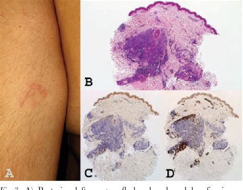 Figure 2 From Primary Cutaneous Marginal Zone Bcell Lymphoma With