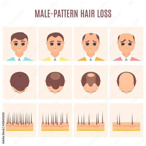 Male Pattern Hair Loss Set Stages Of Baldness In Men Treatment Result