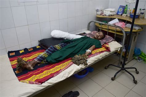 Bangladesh Tree Man Undergoes First Operation In Dhaka Medical
