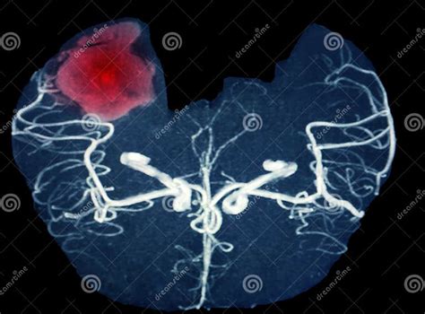 Imagen De Angiografía De Resonancia Magnética O Cerebral Mra De La
