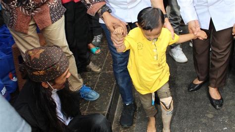 Bantuan Kaki Dan Tangan Palsu Bagi Penyandang Disabilitas