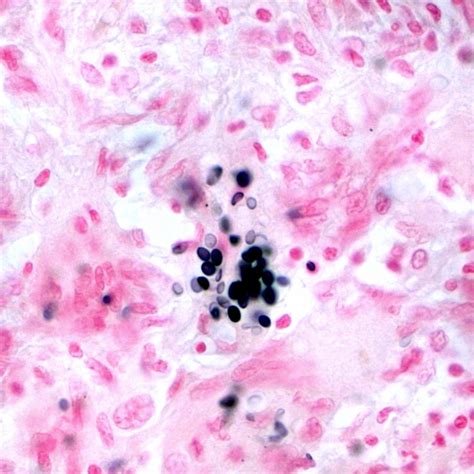 Cryptococcus Neoformans Mucicarmine Stain