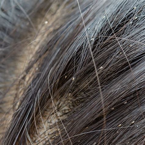 How To Get Rid Of Lice Eggs In Hair