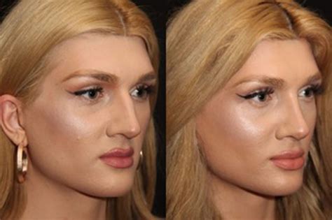 Facial Feminization Surgery Toronto Solomon Facial Plastic