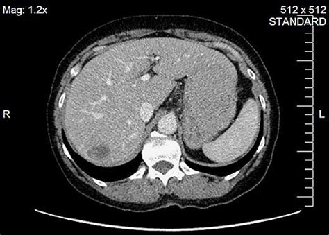 A Liver Mass Measuring 2 9 Cm In Segment 6 7 Of The Liver Is Shown On