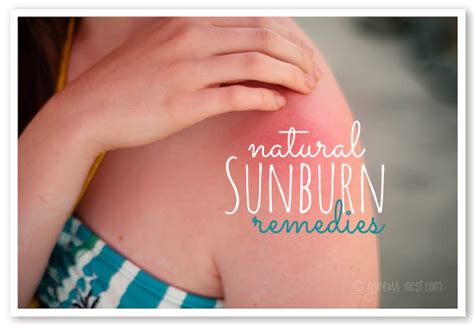 Natural Sunburn Remedies Gwens Nest