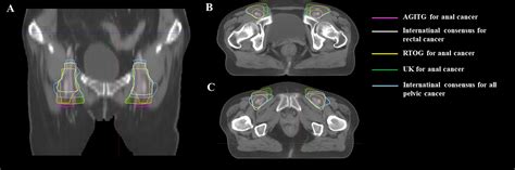 Inguinal Nodal Clinical Target Volume Delineation Based On Analysis Of