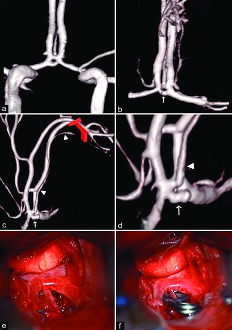 A D Three Dimensional Digital Subtraction Angiography 3d Dsa On