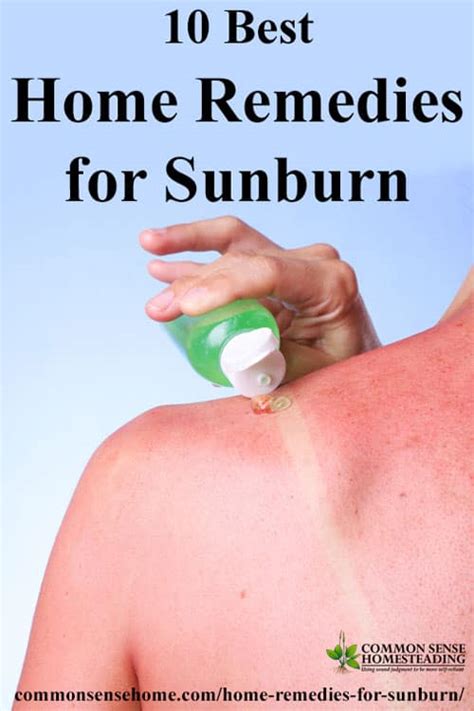 Whats Good For Sunburn Check Out These Home Remedies For Sunburn